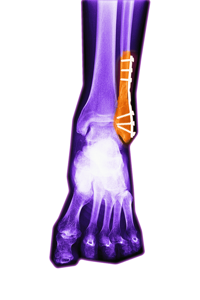 Foot And Ankle Fractures - - Semih Ayanoglu MD - Treatments & Practices